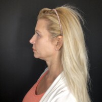 Silent Lift by Dr. Scott Gerrish | Non-Invasive Cosmetic & Regenerative ...